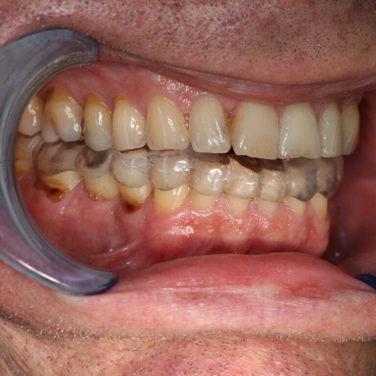 Keilförmige Defekte - ZSC Stuttgart