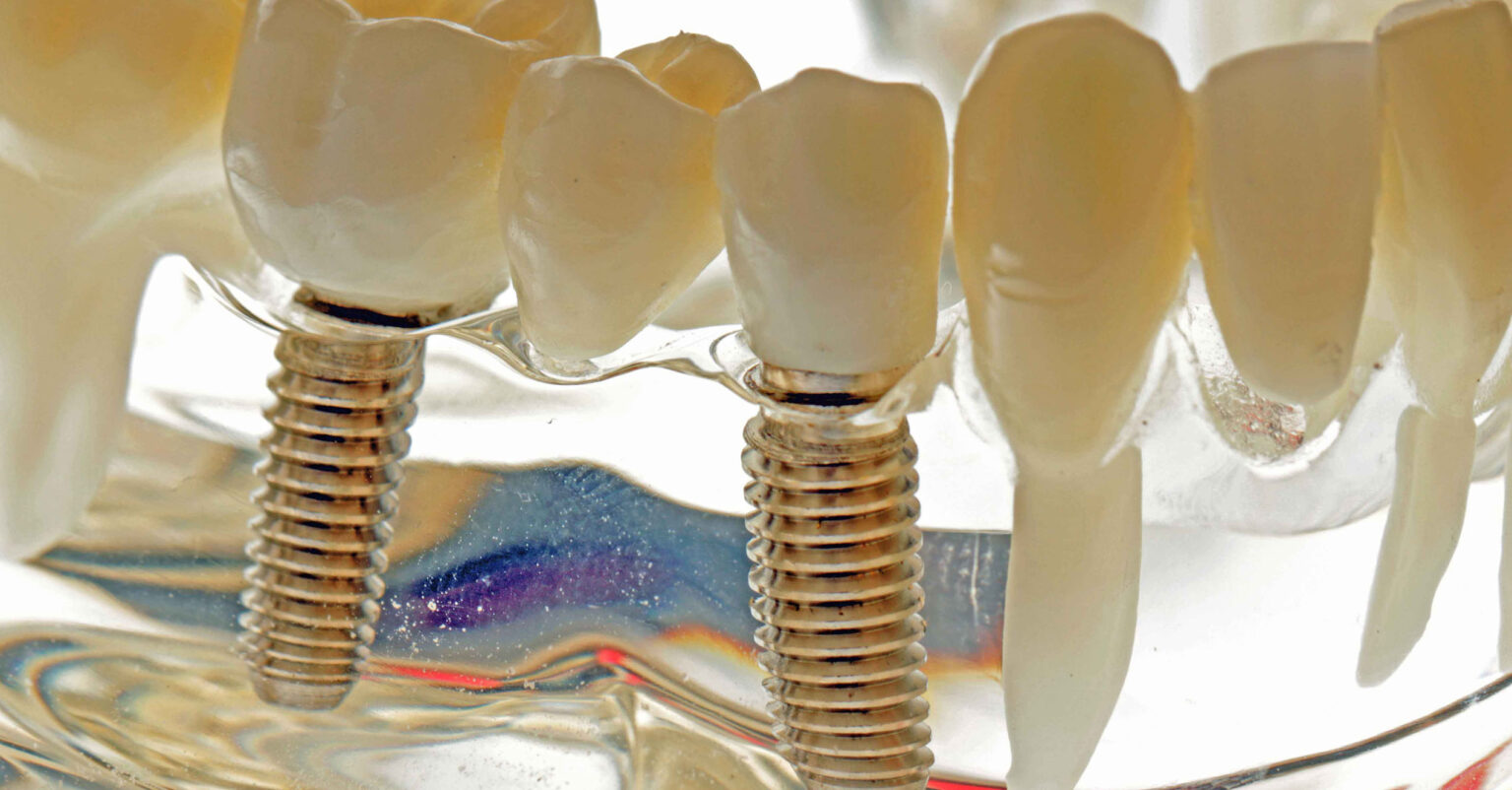 Implantat Zahnersatz - ZSC Stuttgart